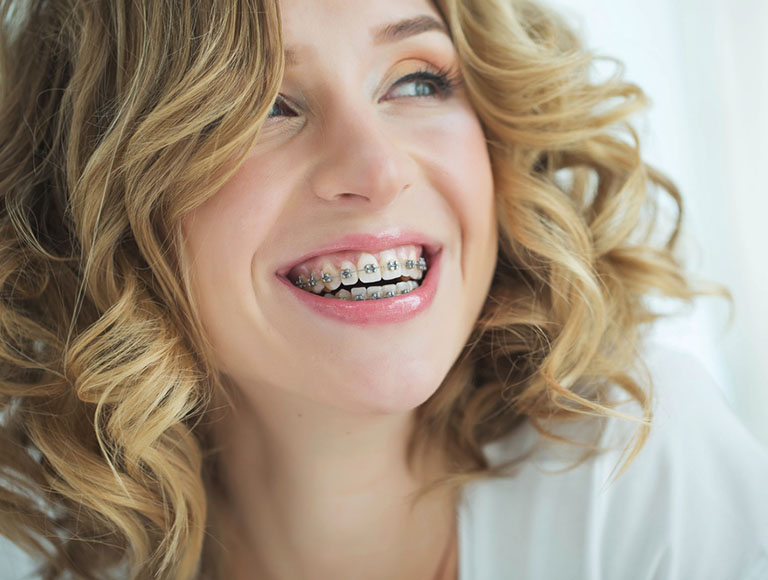 Clear bracket braces - Lake Forest, CA - Dentistry At Its Finest